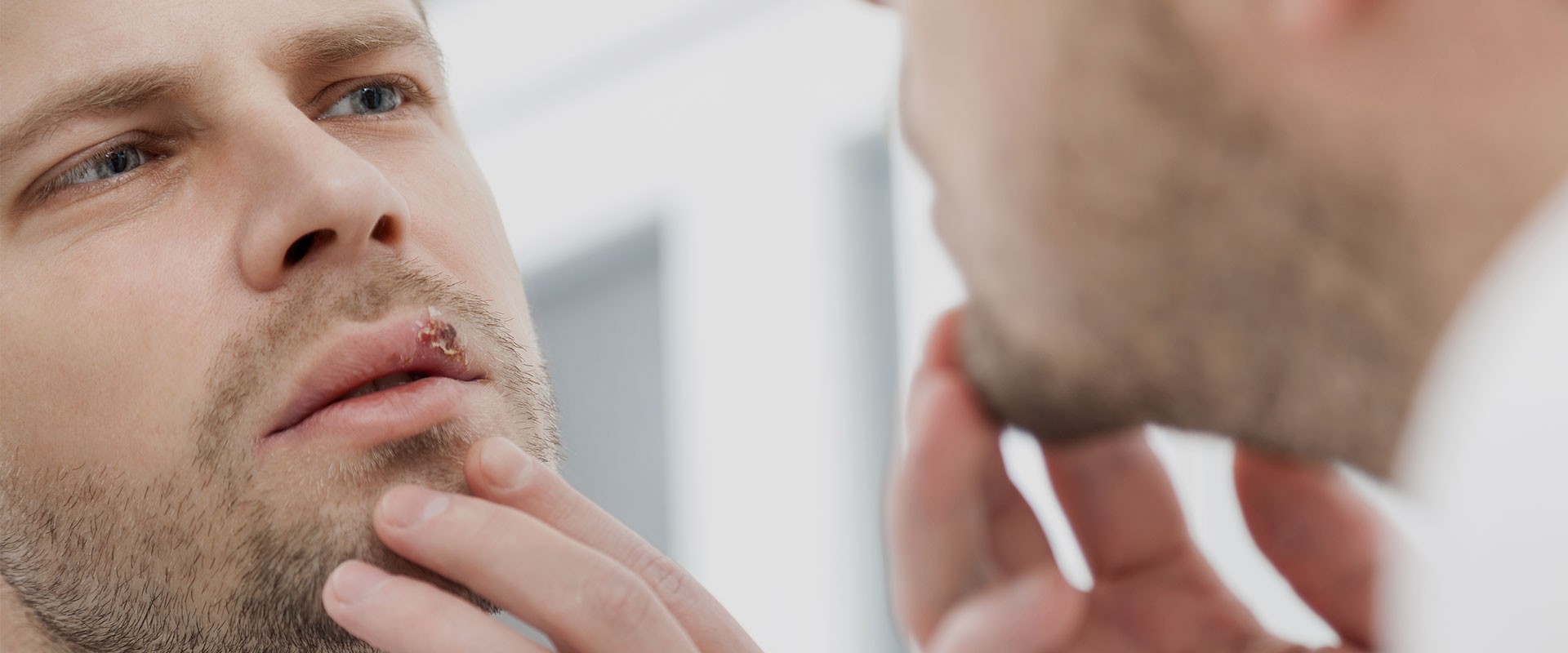 How to get rid of cold sores in the early stages? | COMPEED®