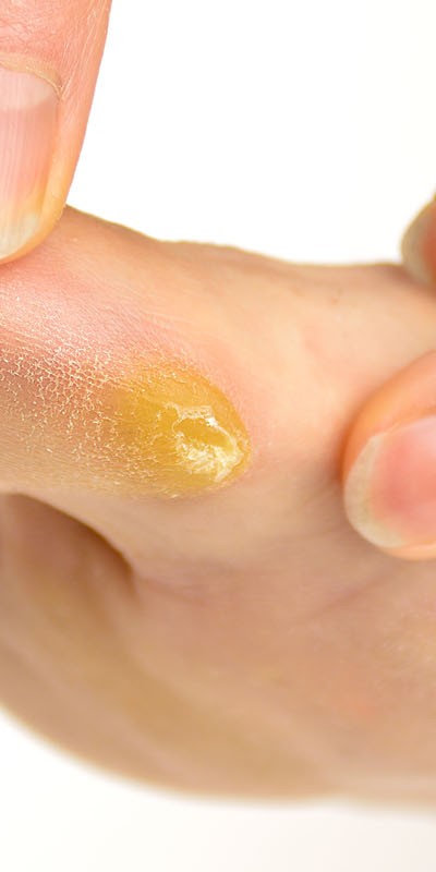 How to treat and remove a callus | COMPEED®